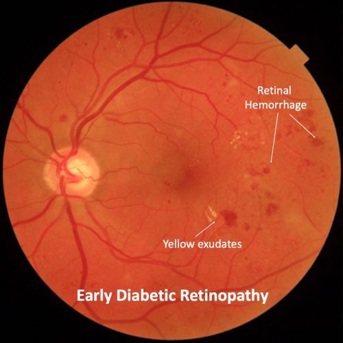 Diabetic Retinopathy | Mr Ellabban Eye Surgery | Yorkshire & Hull