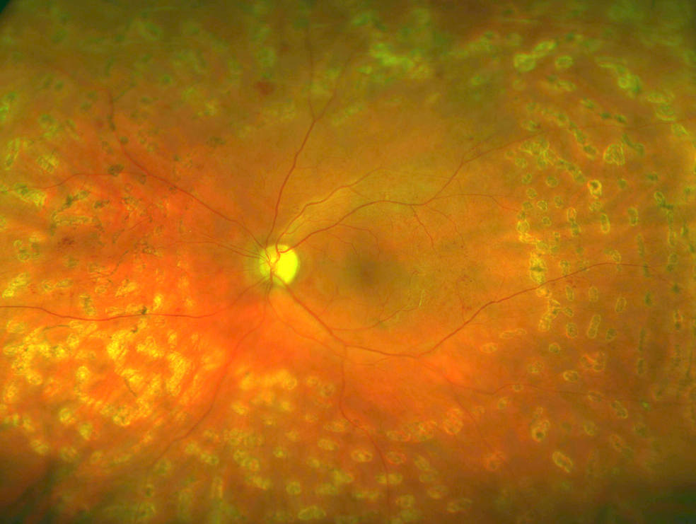 Vitrectomy Surgery I Mr Ellabban | East Riding of Yorkshire & Hull