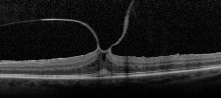 Vitreomacular Traction I Mr Ellabban Eye Surgery | Yorkshire & Hull