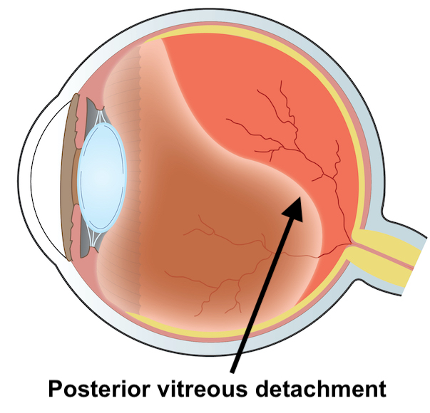 Posterior Vitreous Detachment Floaters