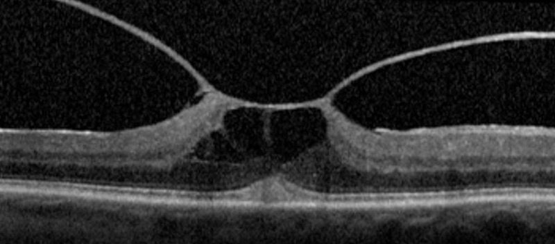Vitreomacular Traction I Mr Ellabban Eye Surgery | Yorkshire & Hull