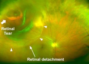 Retinal Detachment I Mr Ellabban Eye Surgery | Yorkshire & Hull