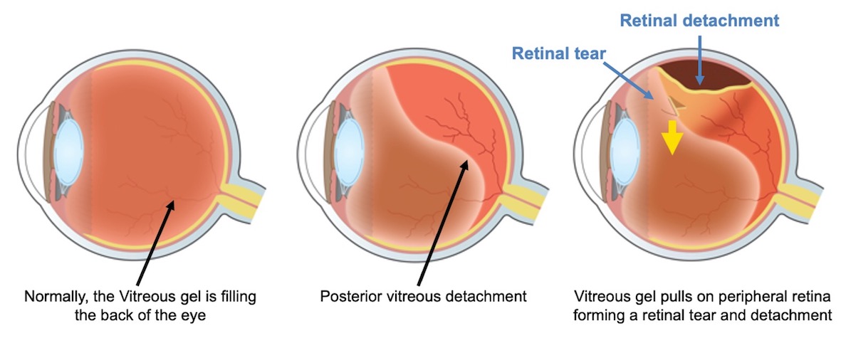Posterior Vitreous Detachment I Mr Ellabban | Yorkshire & Hull