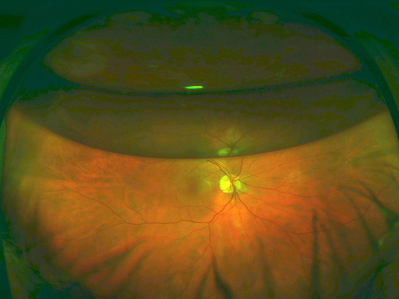 Retinal Detachment I Mr Ellabban Eye Surgery | Yorkshire & Hull