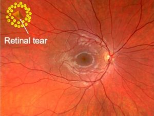 Retinal Laser I Mr Ellabban Eye Surgery | Yorkshire & Hull