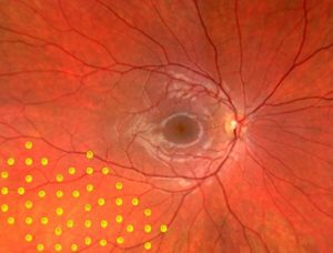 Retinal Laser I Mr Ellabban Eye Surgery | Yorkshire & Hull