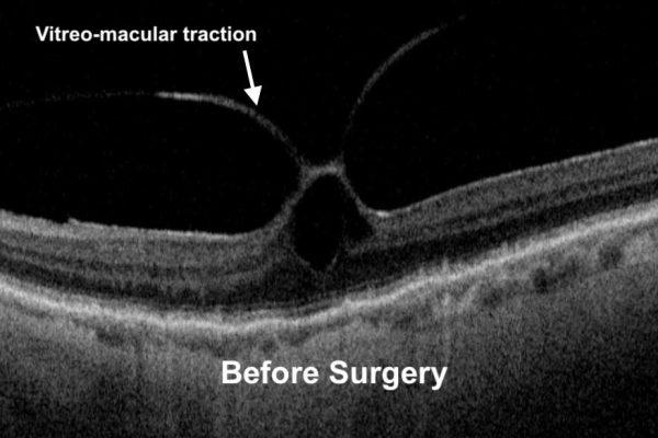 Vitreomacular Traction I Mr Ellabban Eye Surgery | Yorkshire & Hull