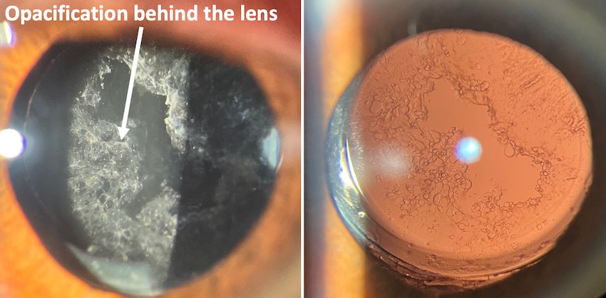 YAG Laser capsulotomy I Mr Ellabban | Yorkshire & Hull