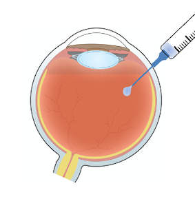 Eye Injection I Mr Ellabban | Experienced Retina Specialist