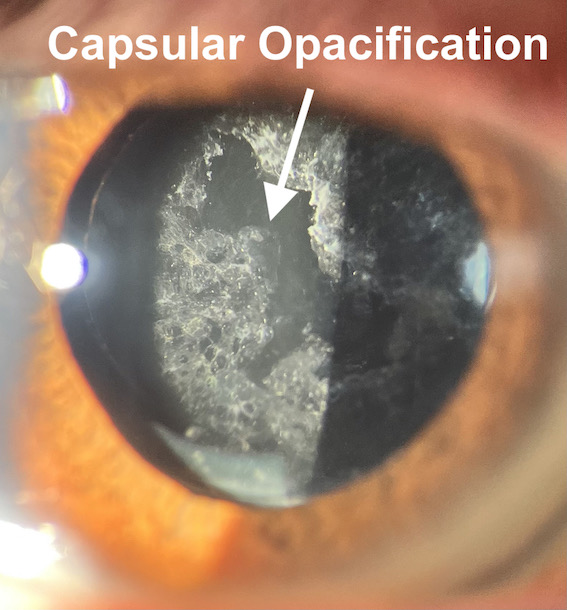 YAG Laser capsulotomy I Mr Ellabban | Yorkshire & Hull