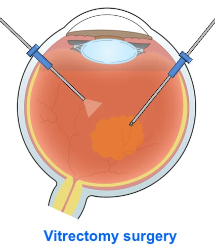 Vitrectomy Surgery I Mr Ellabban | East Riding of Yorkshire and Hull