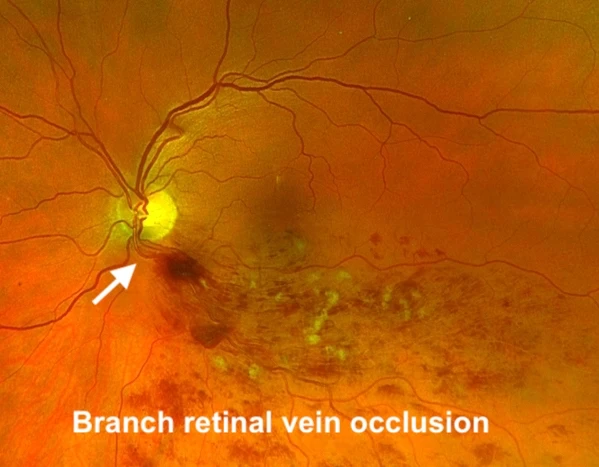 Retinal Vein Occlusion | Mr Ellabban | East Riding of Yorkshire