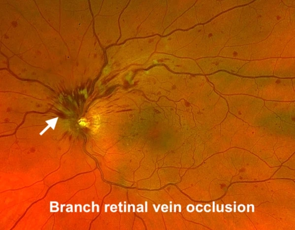 Retinal Vein Occlusion | Mr Ellabban | East Riding of Yorkshire