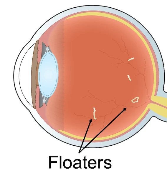 Floaters Treatment I Mr Ellabban | Latest Technology in Eye Surgery