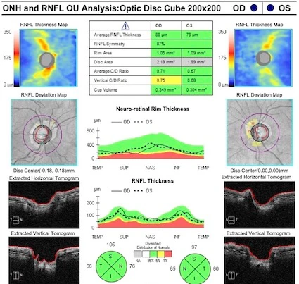 Glaucoma I Mr Ellabban Eye Surgery | Yorkshire & Hull