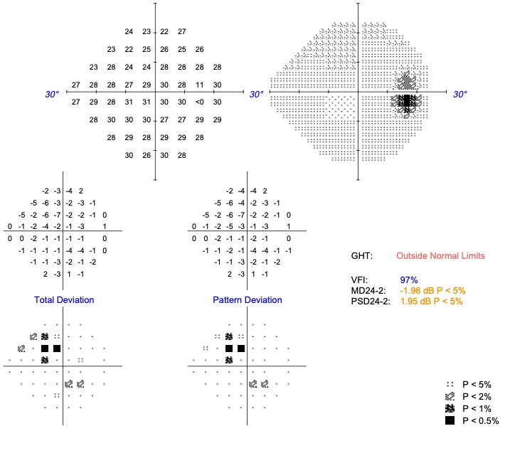 Glaucoma I Mr Ellabban Eye Surgery | Yorkshire & Hull