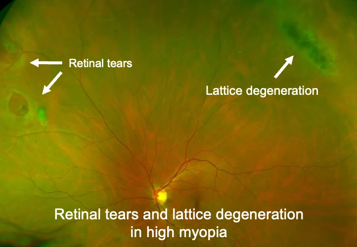 High Myopia | Mr Ellabban | East Riding of Yorkshire