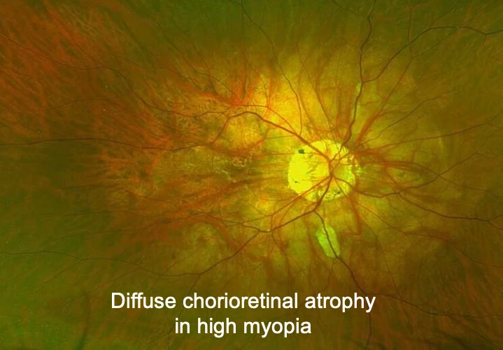 High Myopia | Mr Ellabban | East Riding of Yorkshire