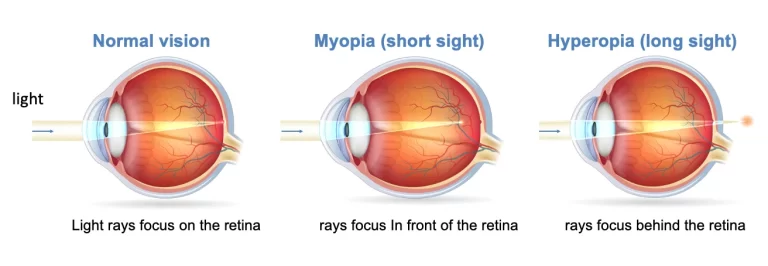 High Myopia | Mr Ellabban | East Riding of Yorkshire
