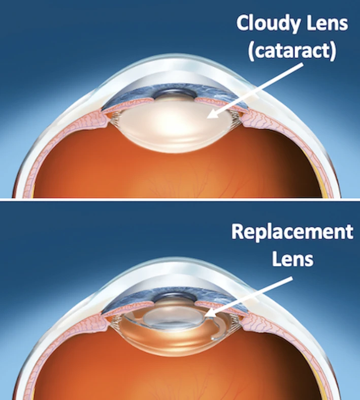 Private Cataract Surgery | Mr Ellabban | Latest Technology in Eye Surgery