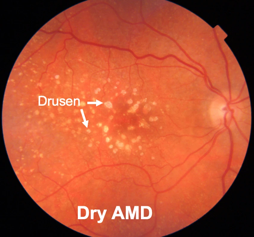 Macular Degeneration | Mr Ellabban I Consultant Retinal Specialist