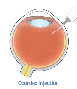 Eye Injection I Mr Ellabban | Experienced Retina Specialist