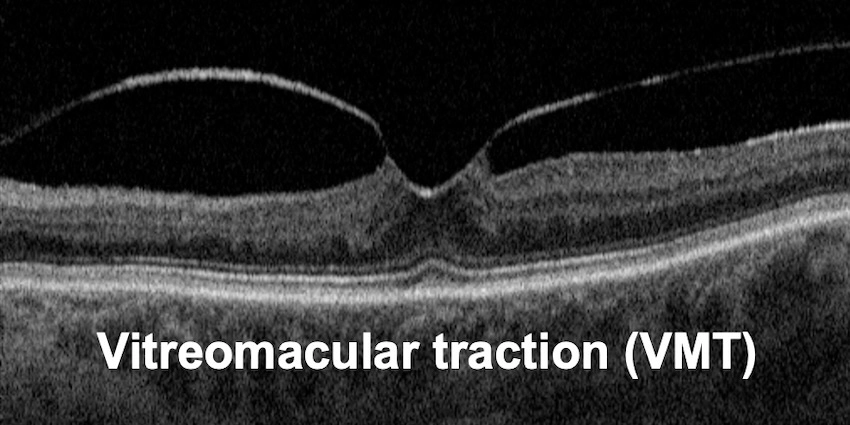 Vitreomacular Traction I Mr Ellabban Eye Surgery | Yorkshire & Hull