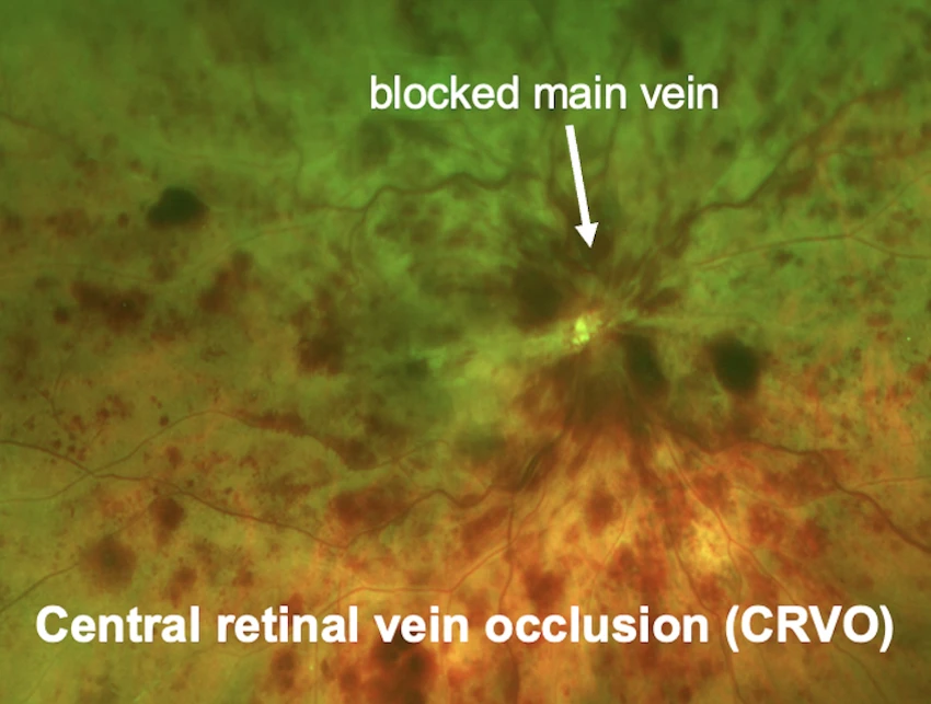 Retinal Vein Occlusion | Mr Ellabban | East Riding of Yorkshire