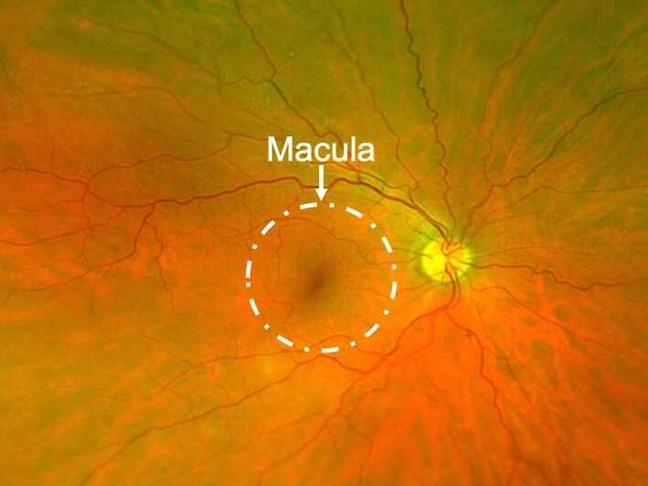 Macular Degeneration | Mr Ellabban I Consultant Retinal Specialist