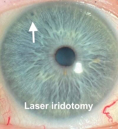 YAG Laser Iridotomy I Mr Ellabban Eye Surgery | Yorkshire & Hull